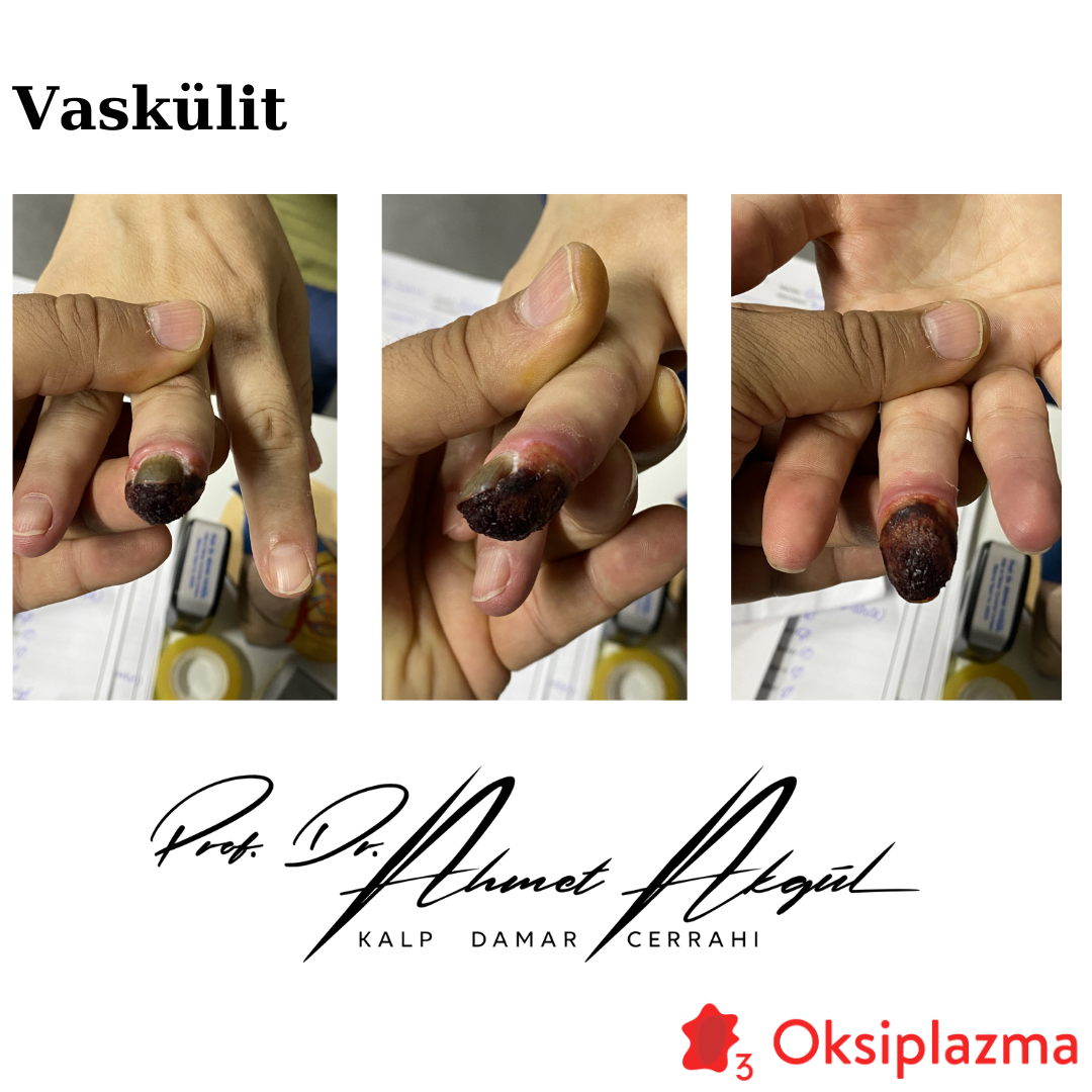 Amputasyon: Nedenleri, Süreci ve Etkileri - Prof. Dr. Ahmet AKGÜL - İç ...